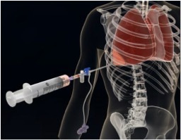 Biopsia de pleura, ¿Que debemos saber? :: Oncología y Cuidados Paliativos
